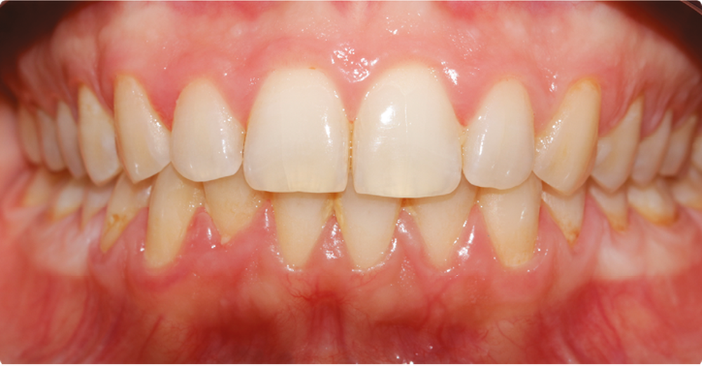 Nouvelle classification… parodontite stade 1 grade A – L'Information ...