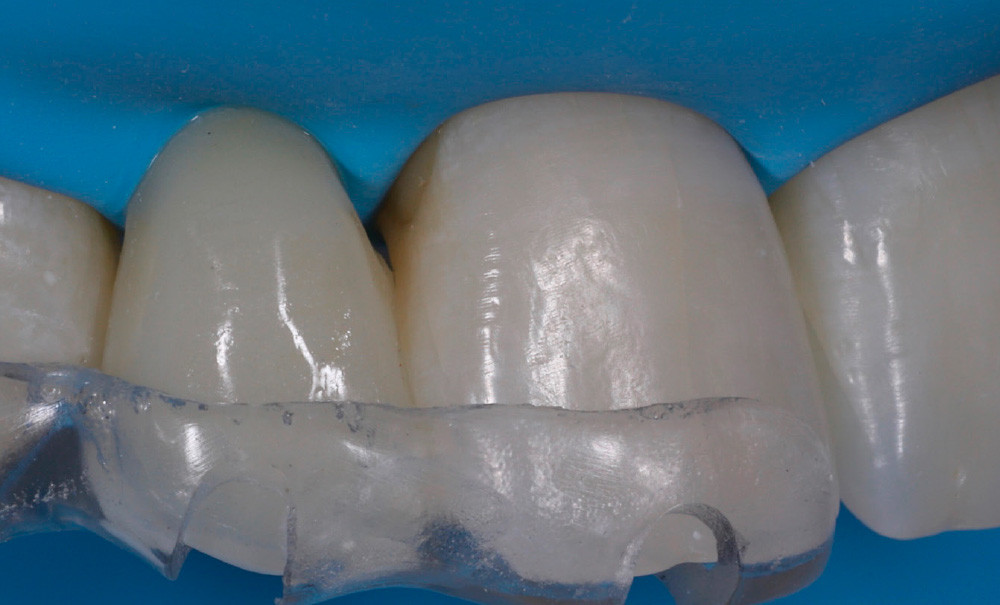 L’évidence du bridge collé à une ailette pour le remplacement d’une ...