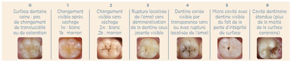 Icdas Caries Classification