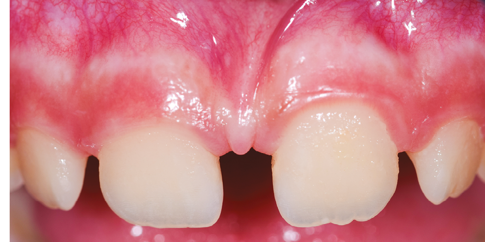 Les frénectomies : indications et techniques chirurgicales – L ...