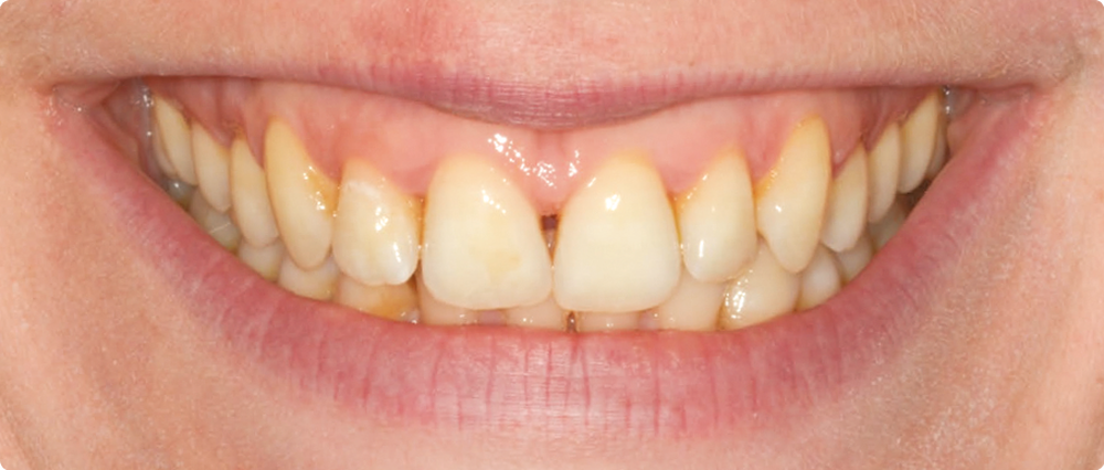 Nouvelle classification… parodontite stade 1 grade B #4 – L'Information ...