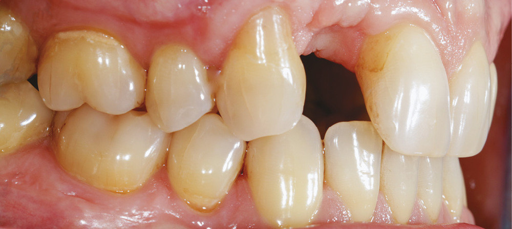 Édentement antérieur : gestion numérique d’un bridge collé cantilever ...