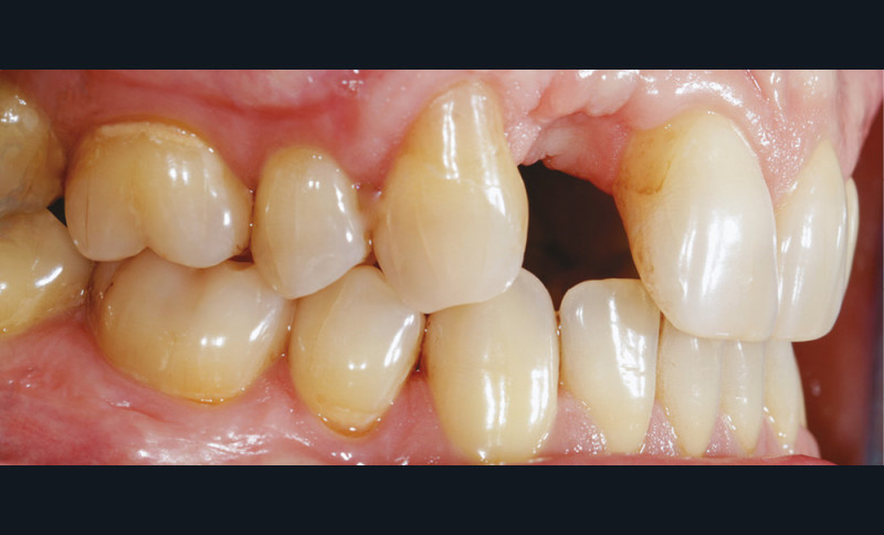 Édentement antérieur : gestion numérique d’un bridge collé cantilever ...