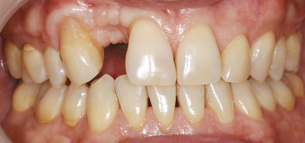 Édentement antérieur : gestion numérique d’un bridge collé cantilever ...