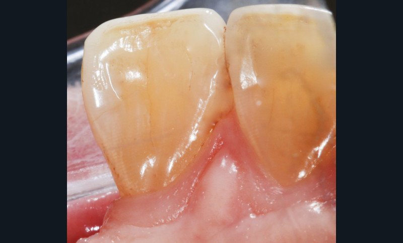 Édentement antérieur : gestion numérique d’un bridge collé cantilever ...