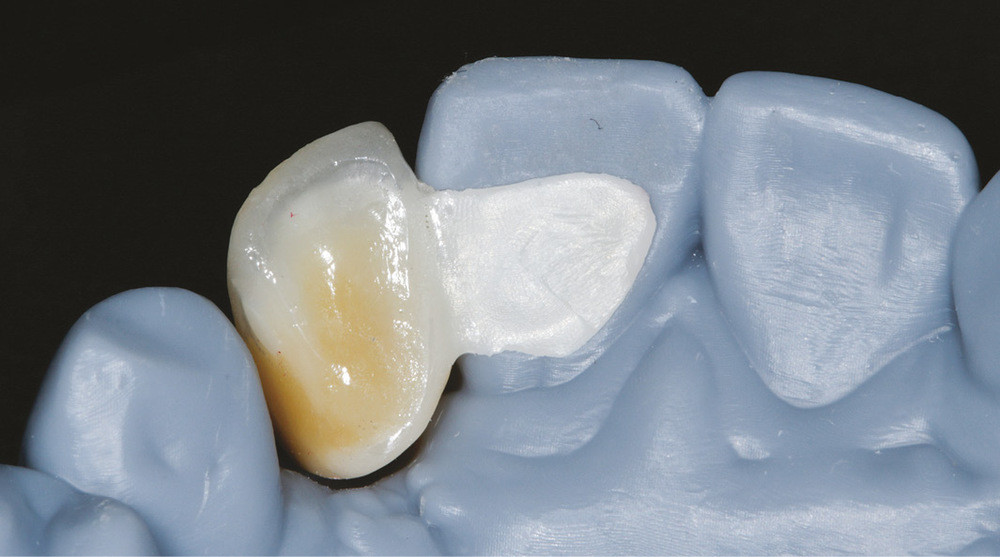 Édentement antérieur : gestion numérique d’un bridge collé cantilever ...