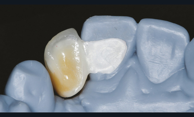 Édentement antérieur : gestion numérique d’un bridge collé cantilever ...