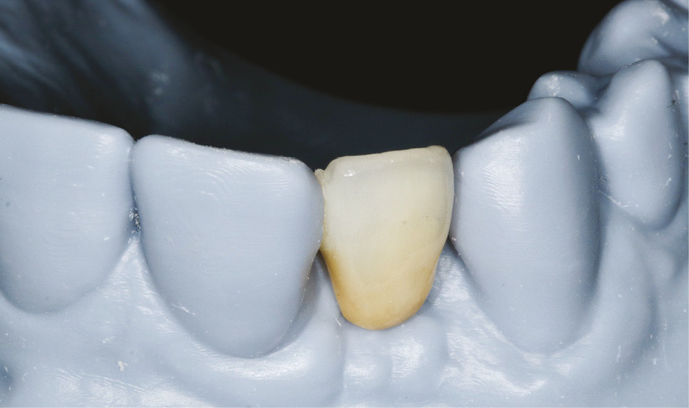 Édentement antérieur : gestion numérique d’un bridge collé cantilever ...