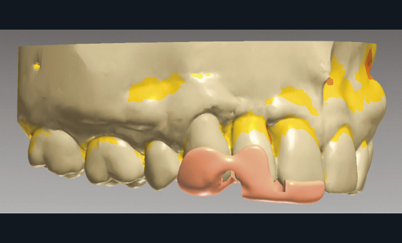 Édentement antérieur : gestion numérique d’un bridge collé cantilever ...