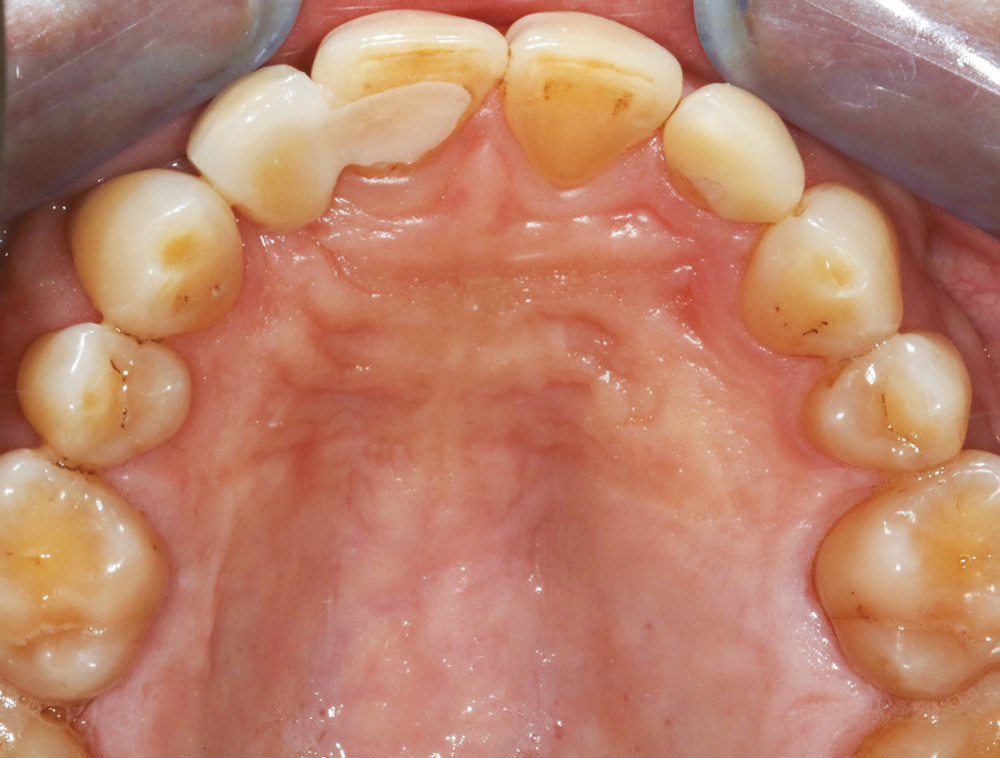 Édentement antérieur : gestion numérique d’un bridge collé cantilever ...