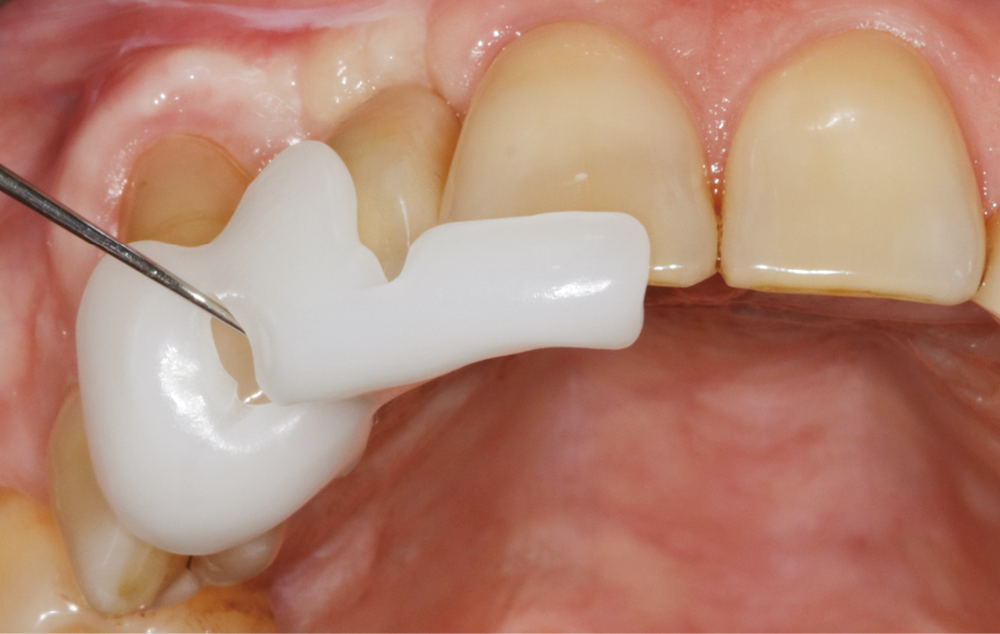 Édentement antérieur : gestion numérique d’un bridge collé cantilever ...