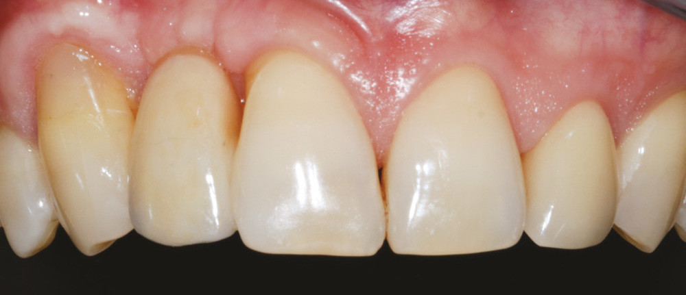 Édentement antérieur : gestion numérique d’un bridge collé cantilever ...