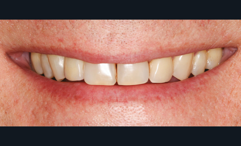 Édentement antérieur : gestion numérique d’un bridge collé cantilever ...