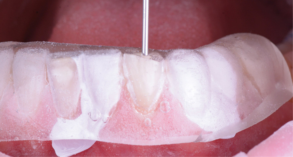 Technique d’injection de composite dans le secteur antérieur – L ...