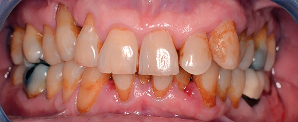 Intérêt de la nouvelle classification des maladies parodontales dans le ...