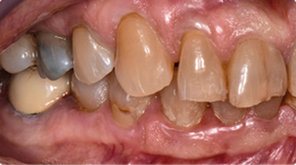 Nouvelle classification… Parodontite – Stade 1 grade C – L'Information ...