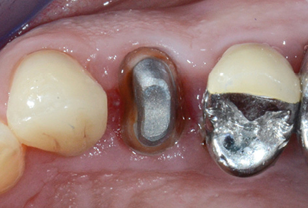 Reconstitutions corono-radiculaires : vers un changement de paradigme ...