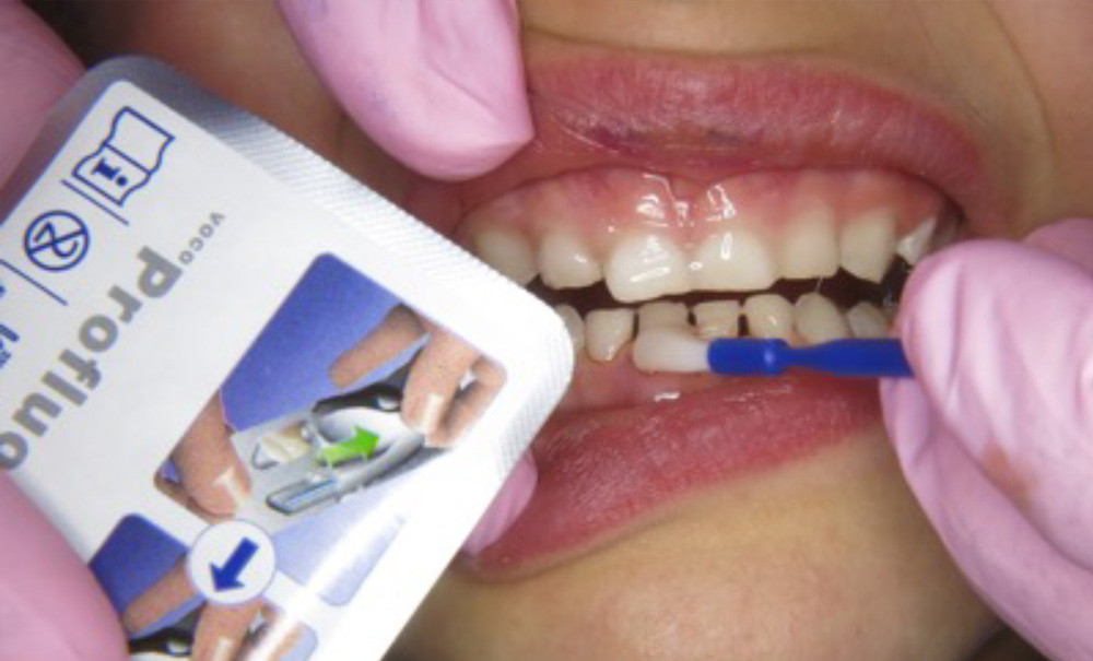 La prophylaxie dentaire individuelle. Facile et accessible – L ...