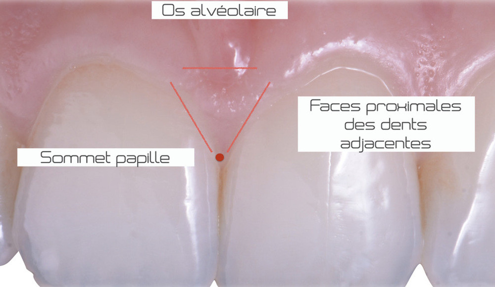 De la préservation papillaire à la gestion des espaces noirs ...