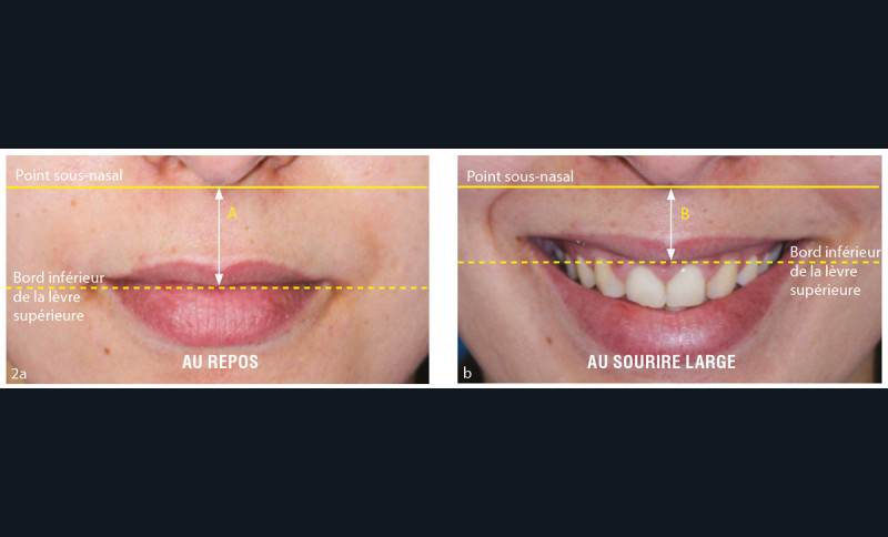Corriger un sourire gingival grâce au repositionnement de la lèvre ...