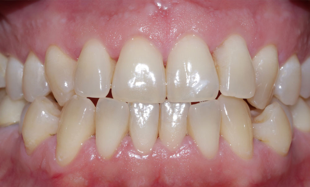 Nouvelle classification #6… parodontite stade 2 grade B – L'Information ...