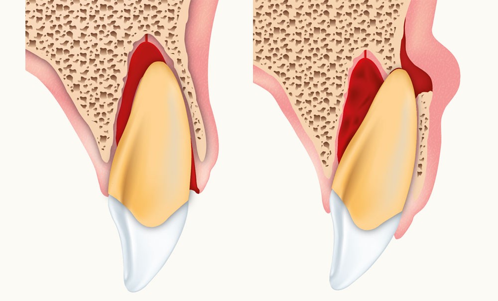 Classification et enregistrement des traumatismes alvéolo-dentaires – L'Information Dentaire