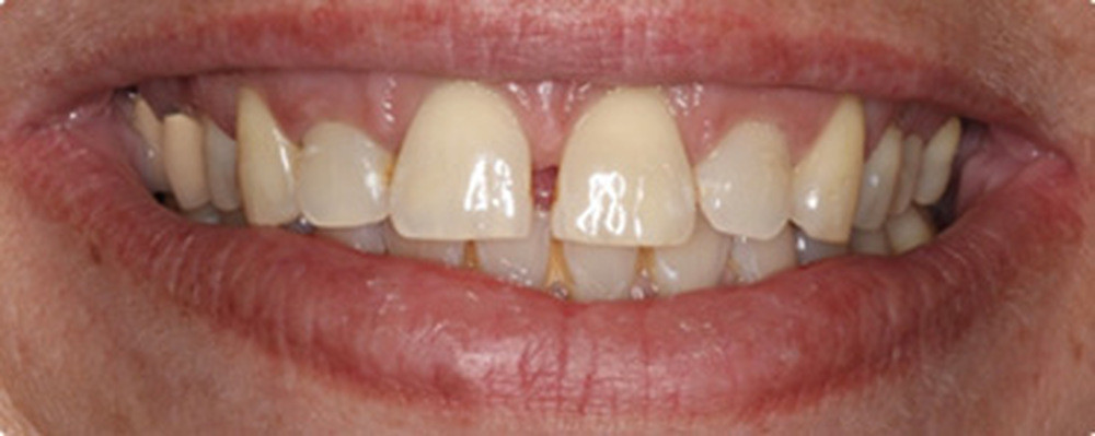 Nouvelle classification… parodontite stade 2 grade C – L'Information ...