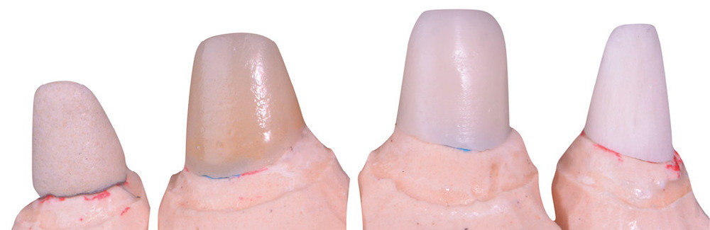 Inlay-core et secteur antérieur, quelles solutions pour optimiser le ...