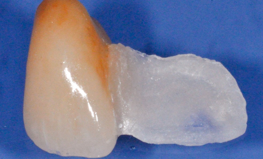 Bridge collé mono-ailette : l’origine – L'Information Dentaire