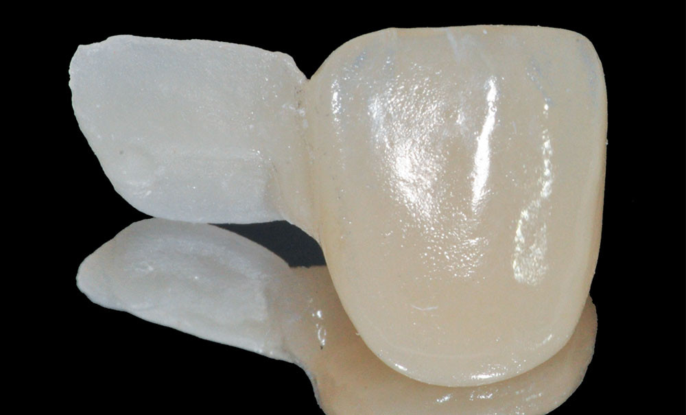 Il était une fois… le bridge collé en extension – L'Information Dentaire