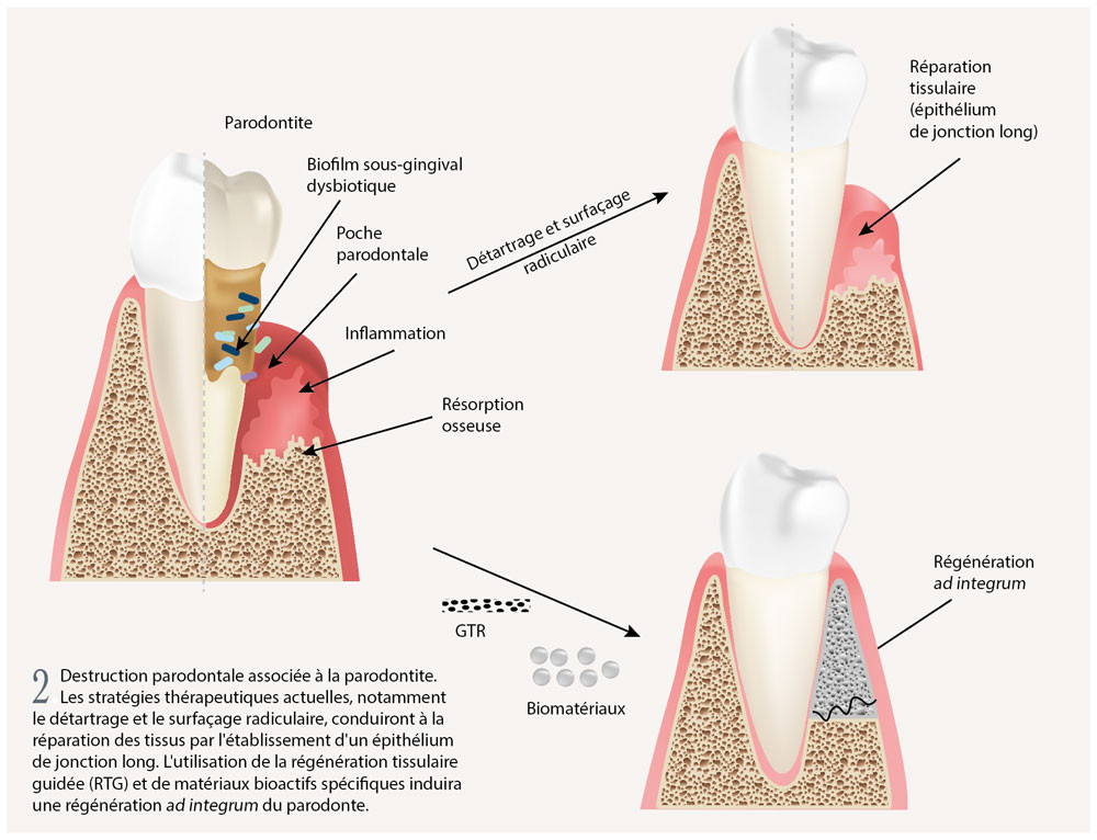 Intérêts des exosomes dans la régénération osseuse et parodontale – L ...