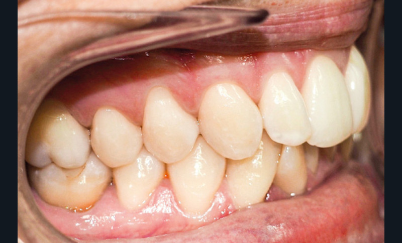 Gestion d’un cas d’extraction d’incisive mandibulaire par technique ...