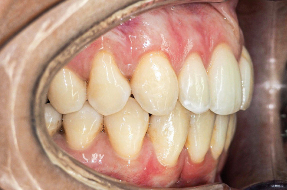 Gestion d’un cas d’extraction d’incisive mandibulaire par technique ... Gestion d’un cas d’extraction d’incisive mandibulaire par technique ...