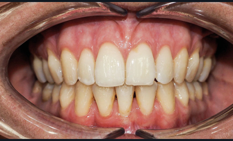 Gestion d’un cas d’extraction d’incisive mandibulaire par technique ... Gestion d’un cas d’extraction d’incisive mandibulaire par technique ...
