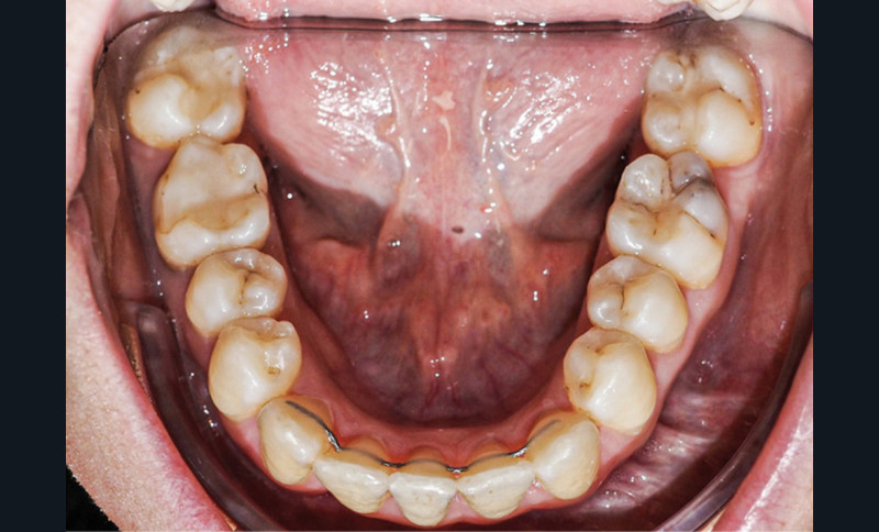 Gestion d’un cas d’extraction d’incisive mandibulaire par technique ...