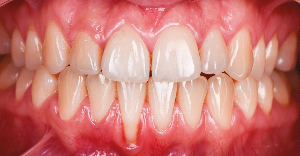 Les frénectomies en questions – L'Information Dentaire