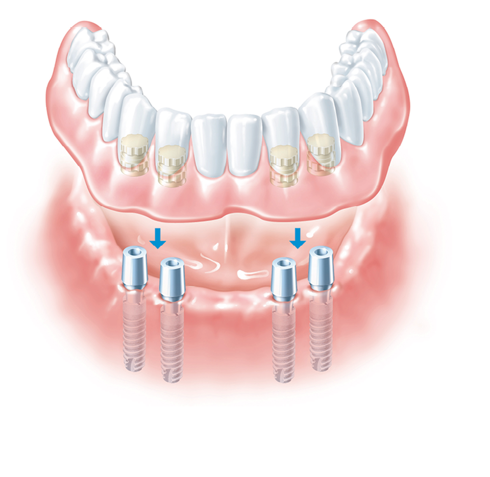 La prothèse complète implantaire sur coiffes télescopes : ça vous parle ...
