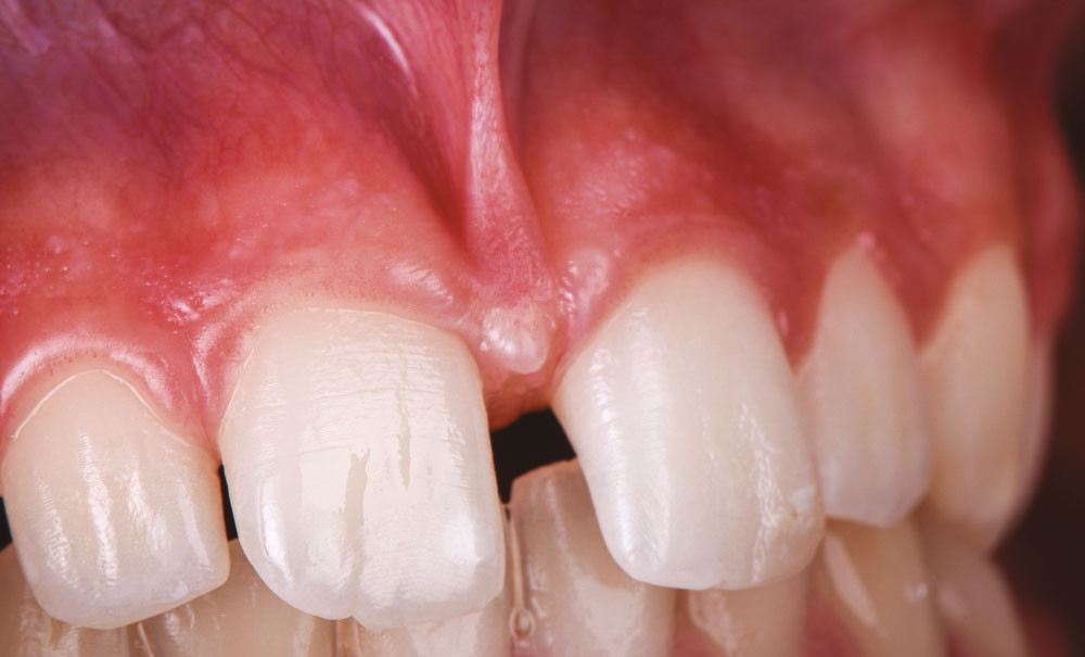 Les frénectomies en questions – L'Information Dentaire