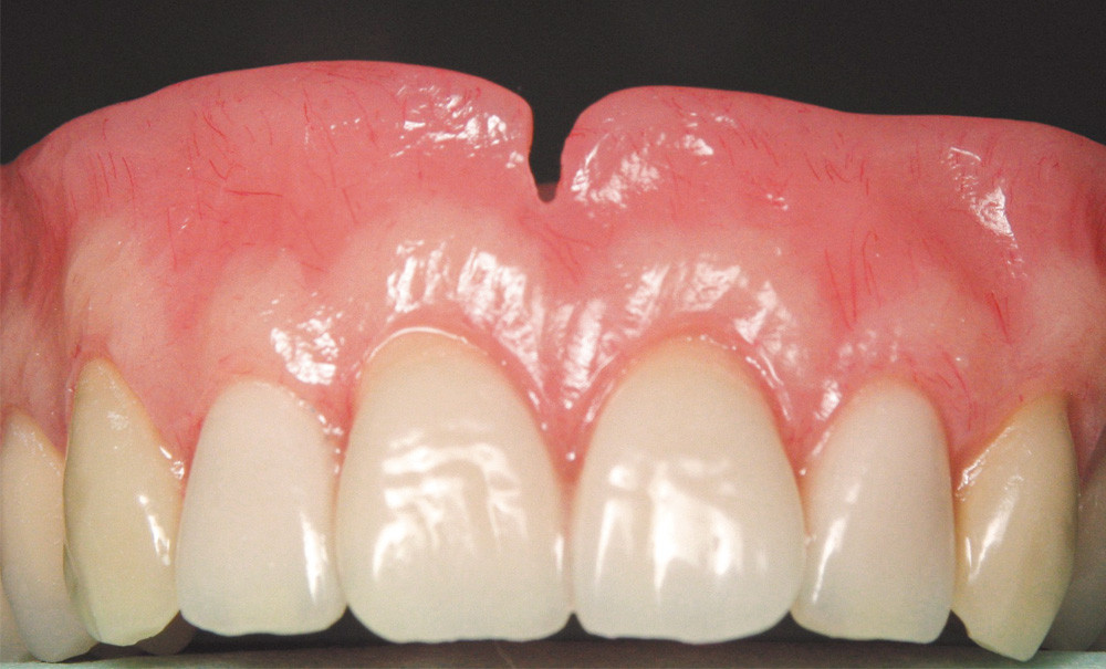 Prothèse transitoire ou immédiate d’usage : quand, comment ? – L ...