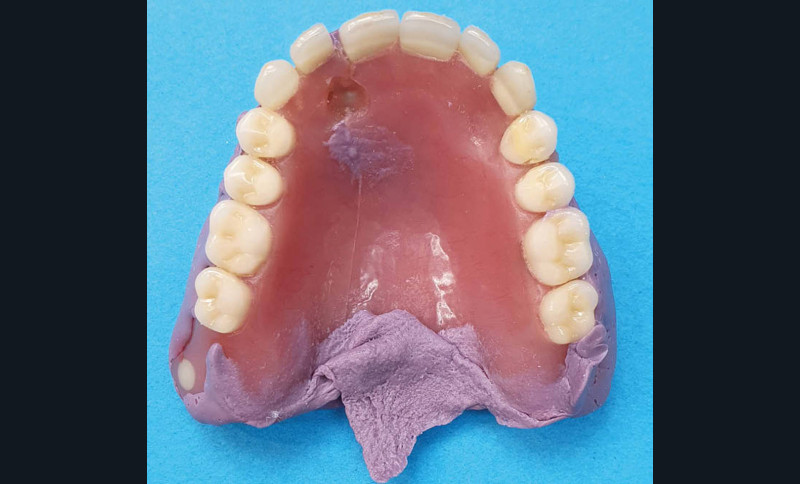 La réfection des bases en résine en prothèse amovible – L'Information ...