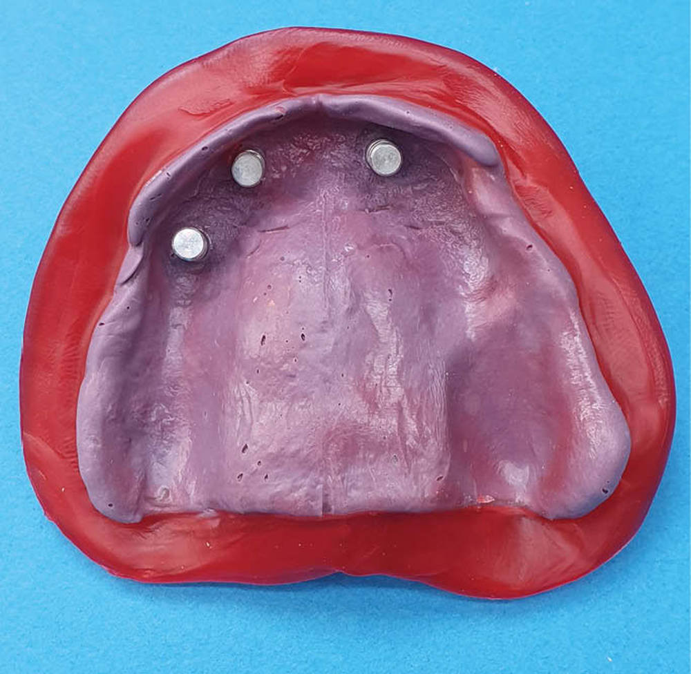 La réfection des bases en résine en prothèse amovible – L'Information ...