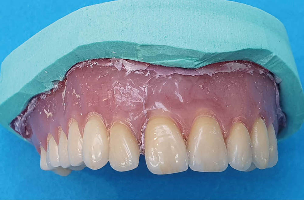 La réfection des bases en résine en prothèse amovible – L'Information ...