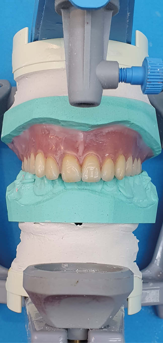 La réfection des bases en résine en prothèse amovible – L'Information ...