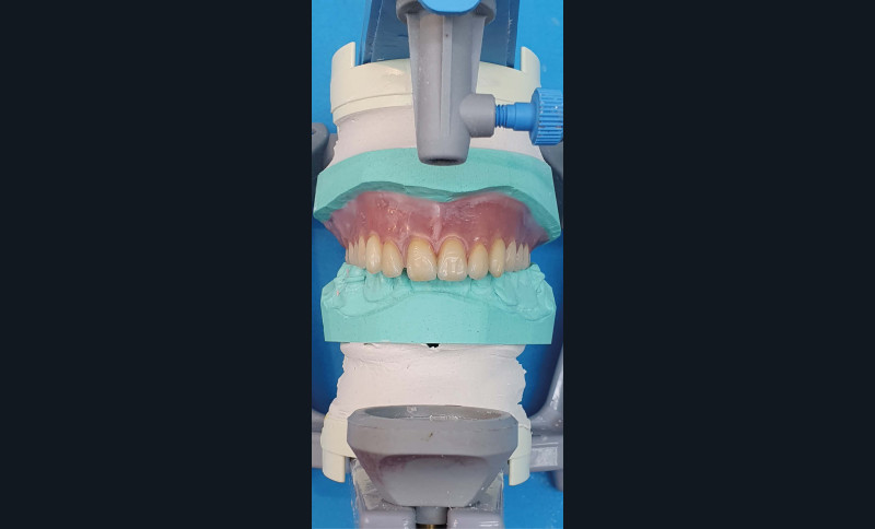 La réfection des bases en résine en prothèse amovible – L'Information ...