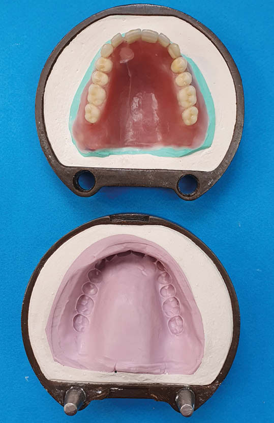 La réfection des bases en résine en prothèse amovible – L'Information ...