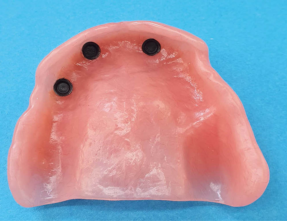 La réfection des bases en résine en prothèse amovible – L'Information ...