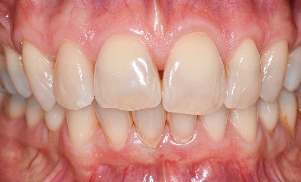 Nouvelle classification… parodontite stade III grade A – L'Information ...