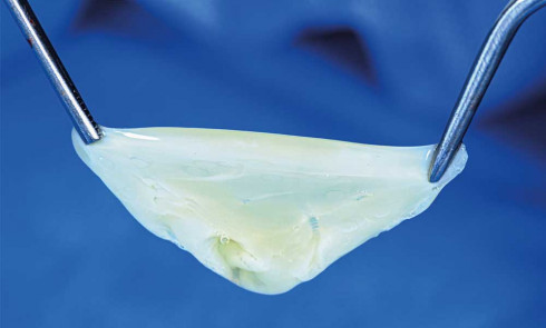 Ingénierie tissulaire en odontologie – L'Information Dentaire