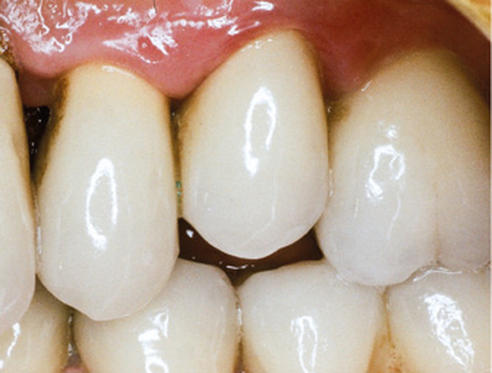 Ingression et inversion d’une dent naturelle délimitée par deux ...