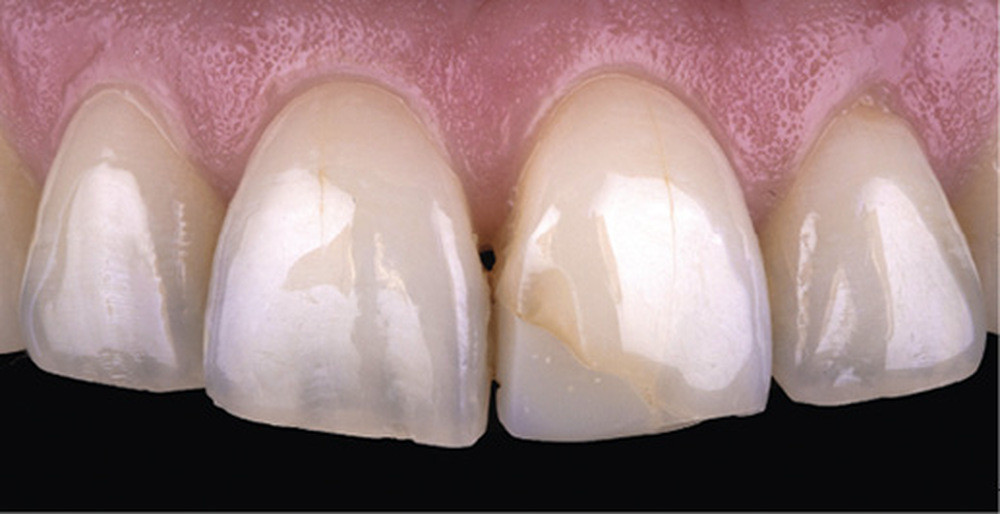 Composites stratifiés et composites injectés : deux philosophies ...